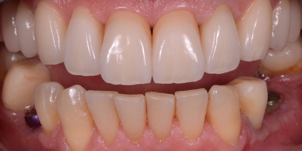 Creation - Ceramet UK Dental Solutions